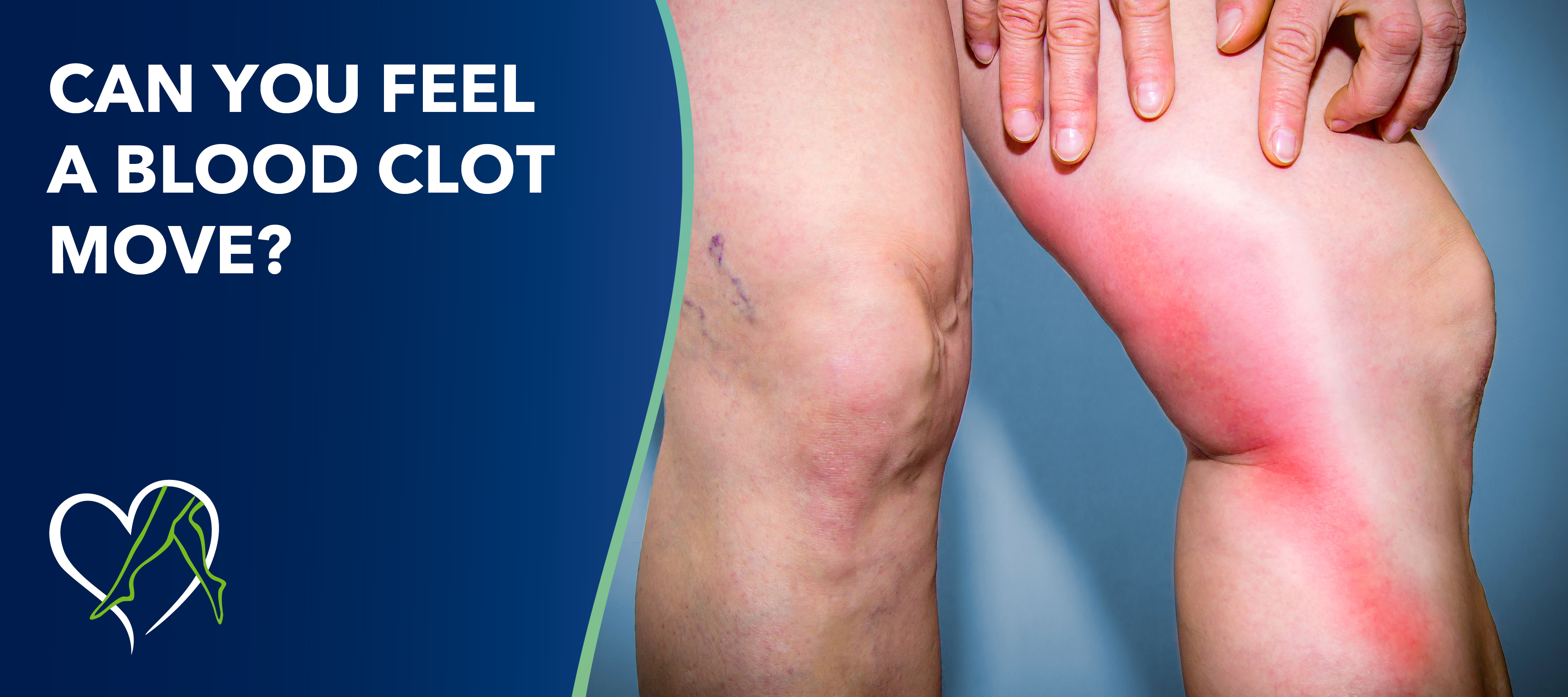 What Does A Blood Clot Behind The Knee Look Like