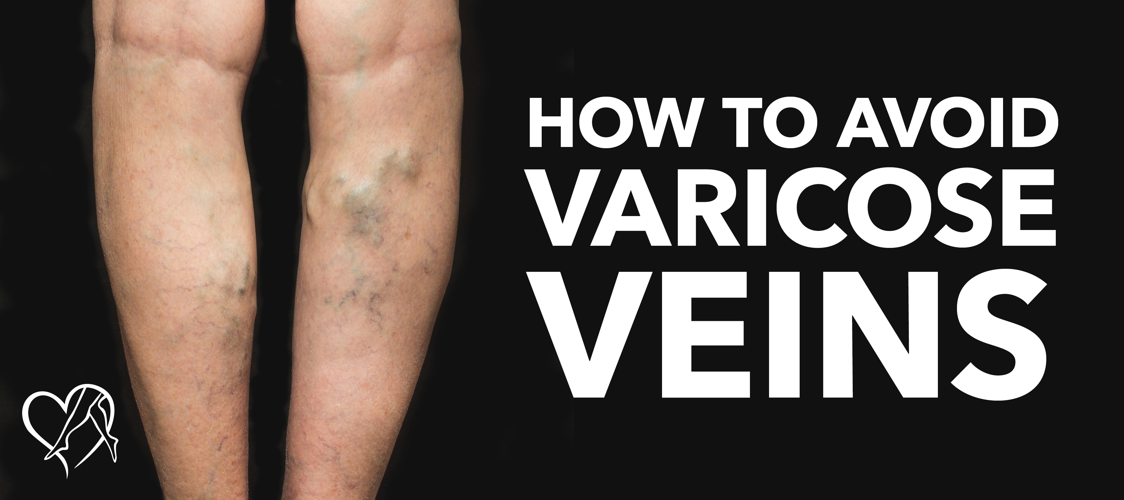 Center for Vein Restoration | Cómo evitar las venas varicosas