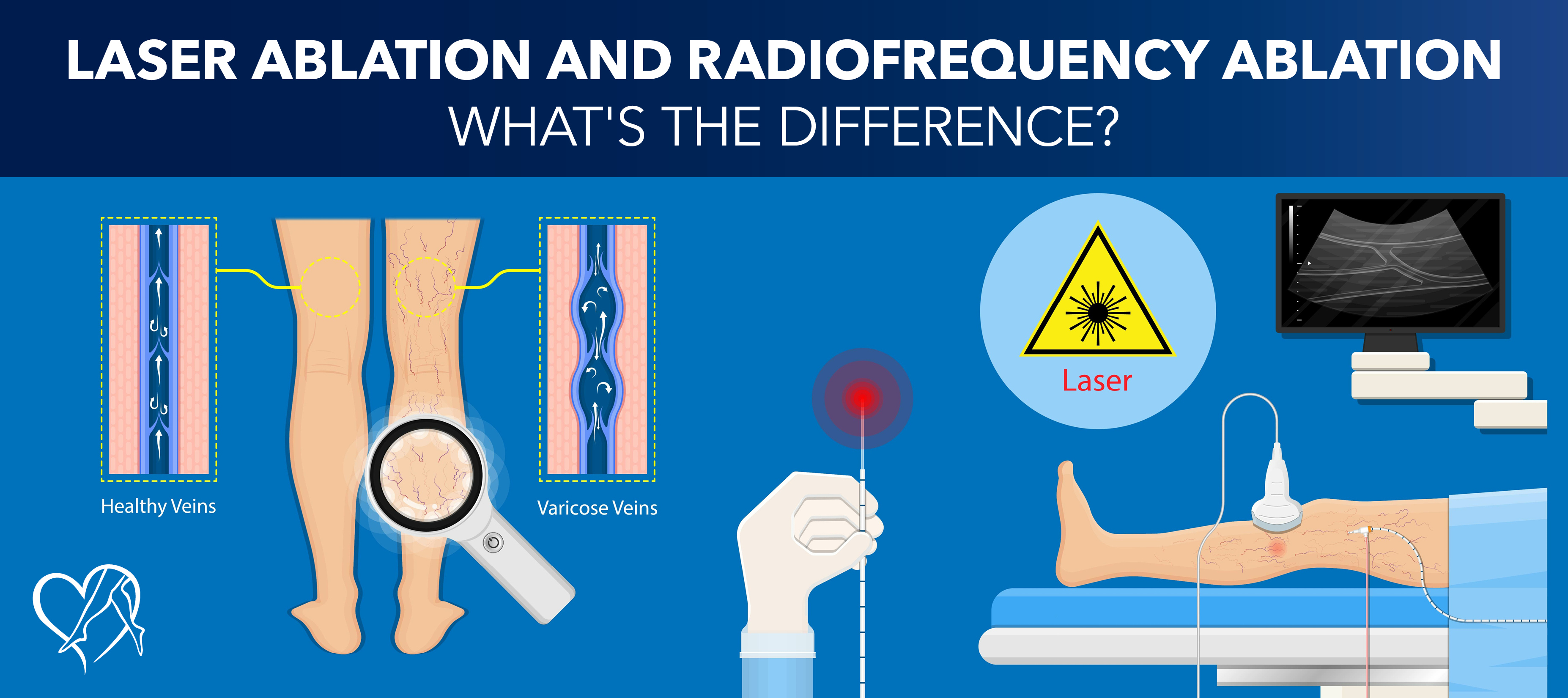 Laser Ablation and Radiofrequency Ablation: What's the Difference?
