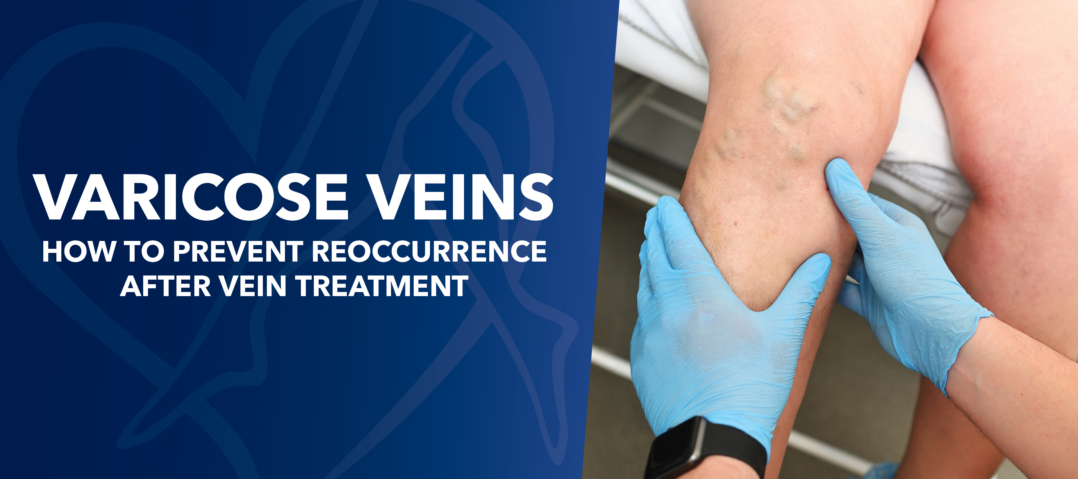 Varicose Veins: How to Prevent Reoccurrence After Vein Treatment