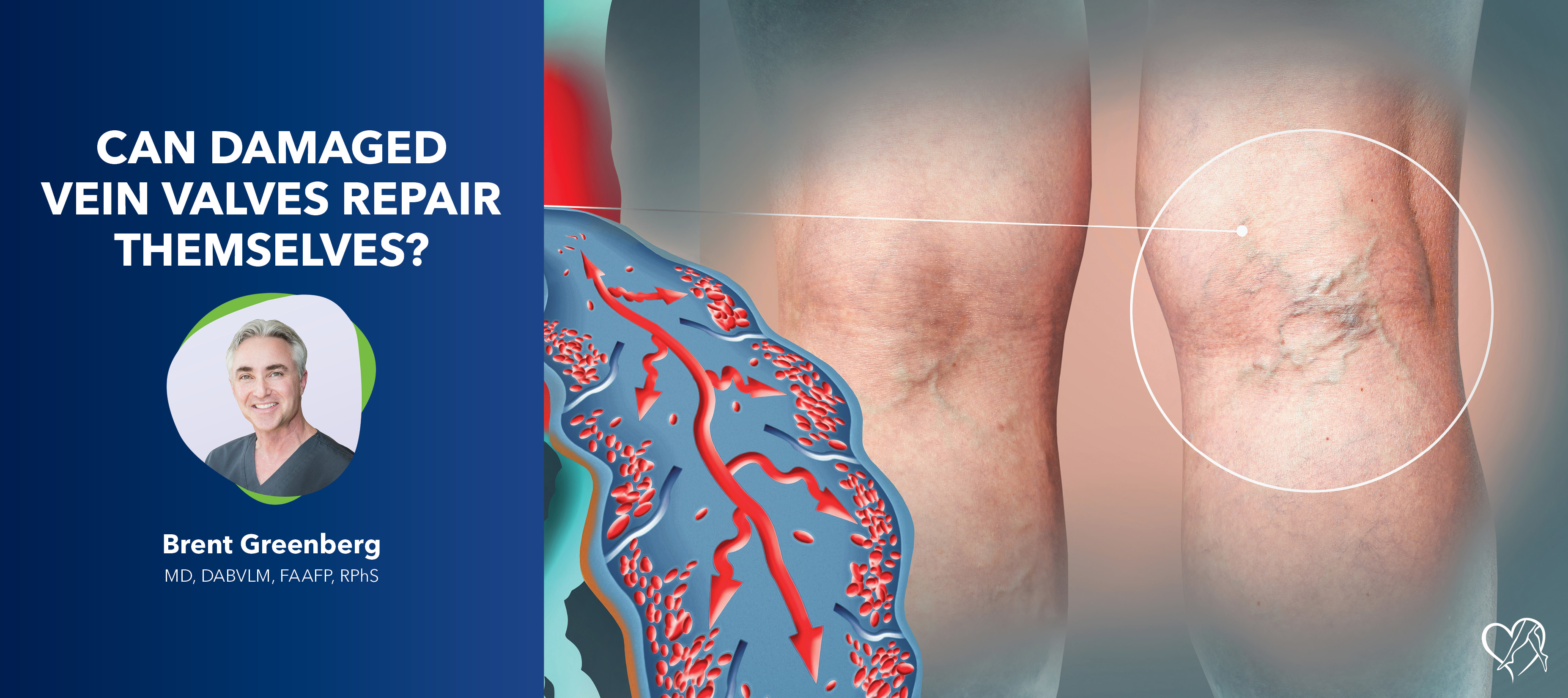 Can Damaged Vein Valves Repair Themselves?