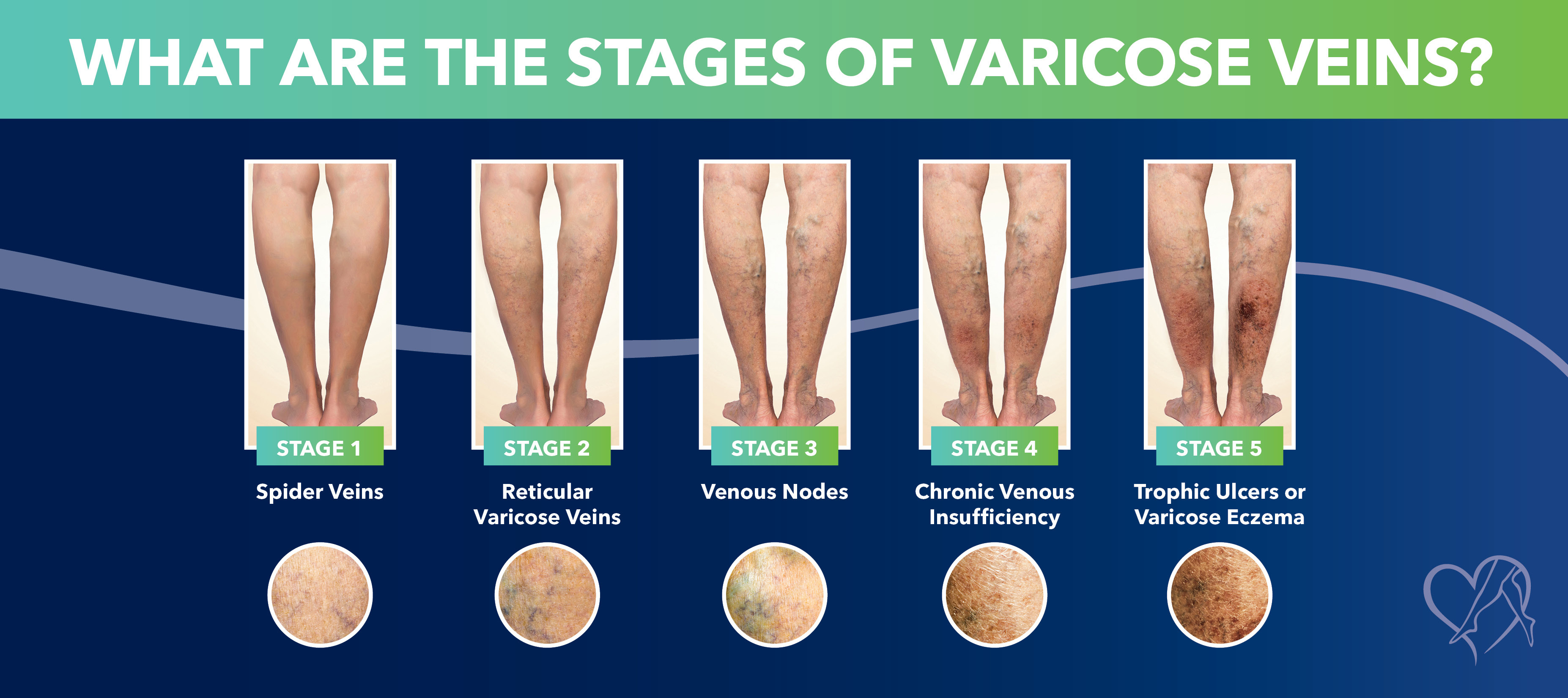 What are the Stages of Varicose Veins?