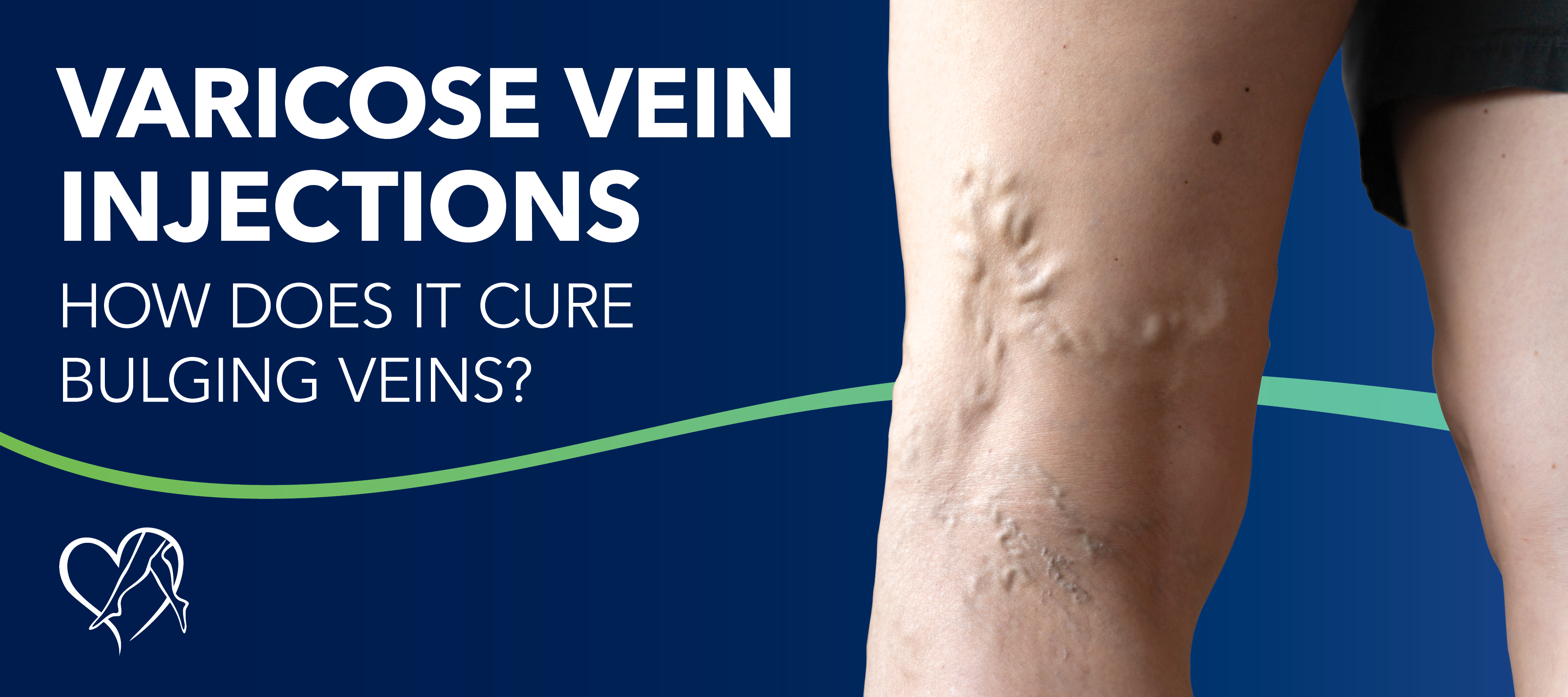 Center for Vein Restoration | Inyecciones para Venas Varicosas: ¿Cómo ...
