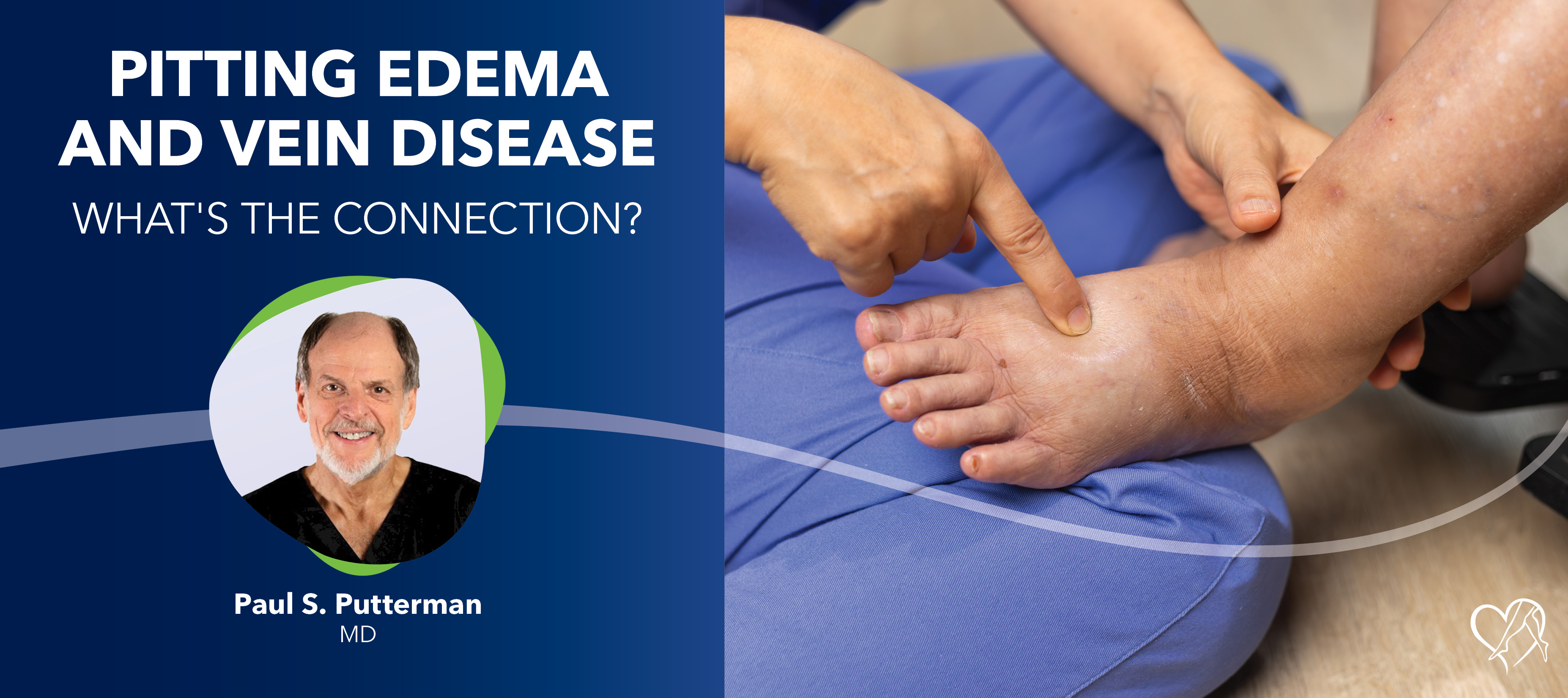 Pitting Edema and Vein Disease: What's the Connection?
