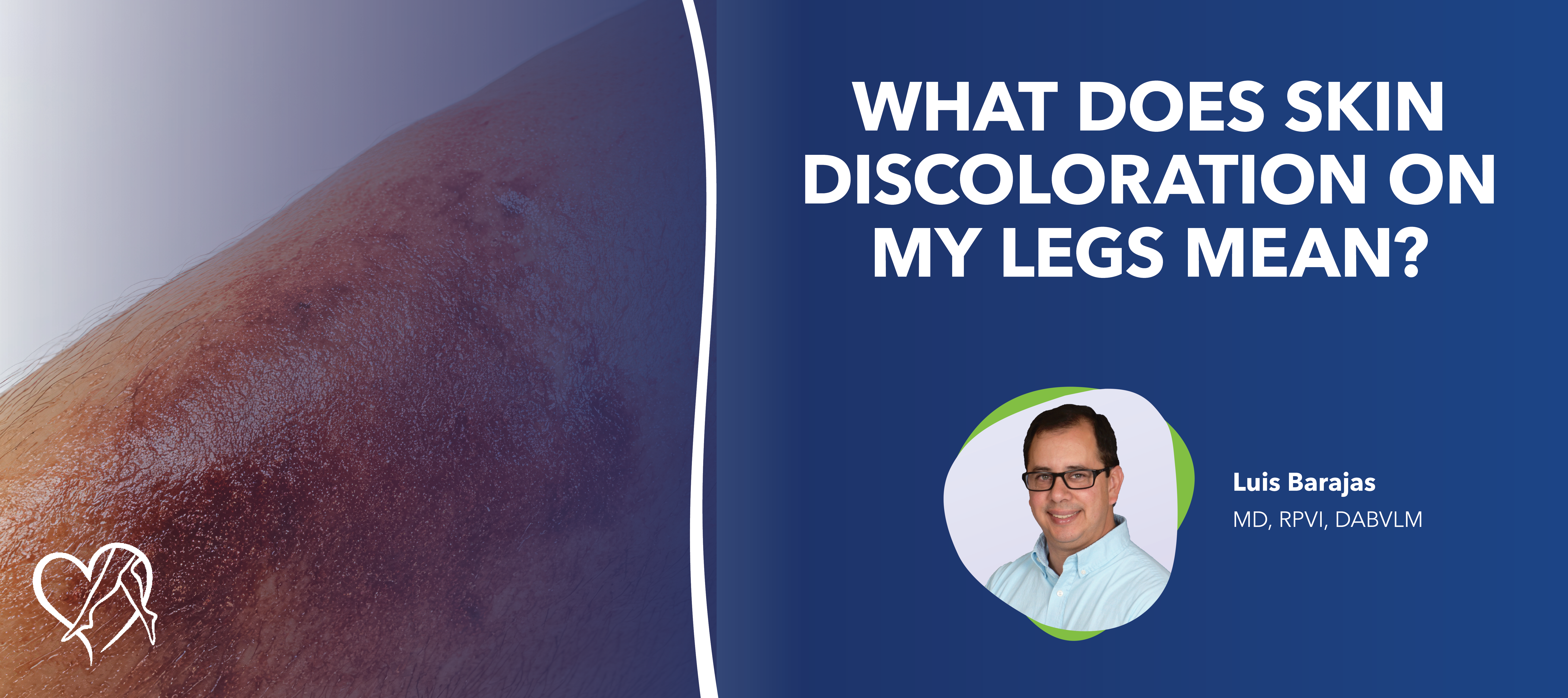 What Does Skin Discoloration on My Legs Mean?