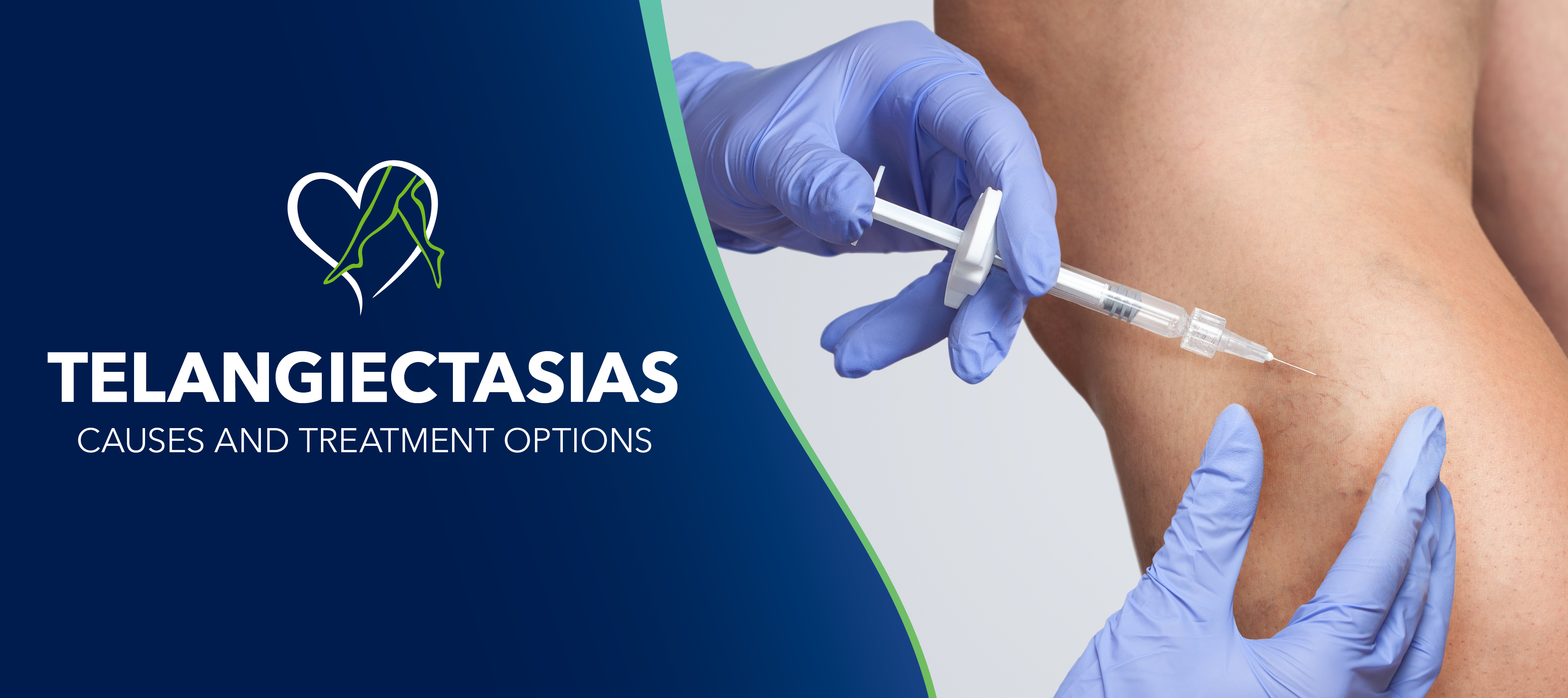 Telangiectasias: Causes and Treatment Options