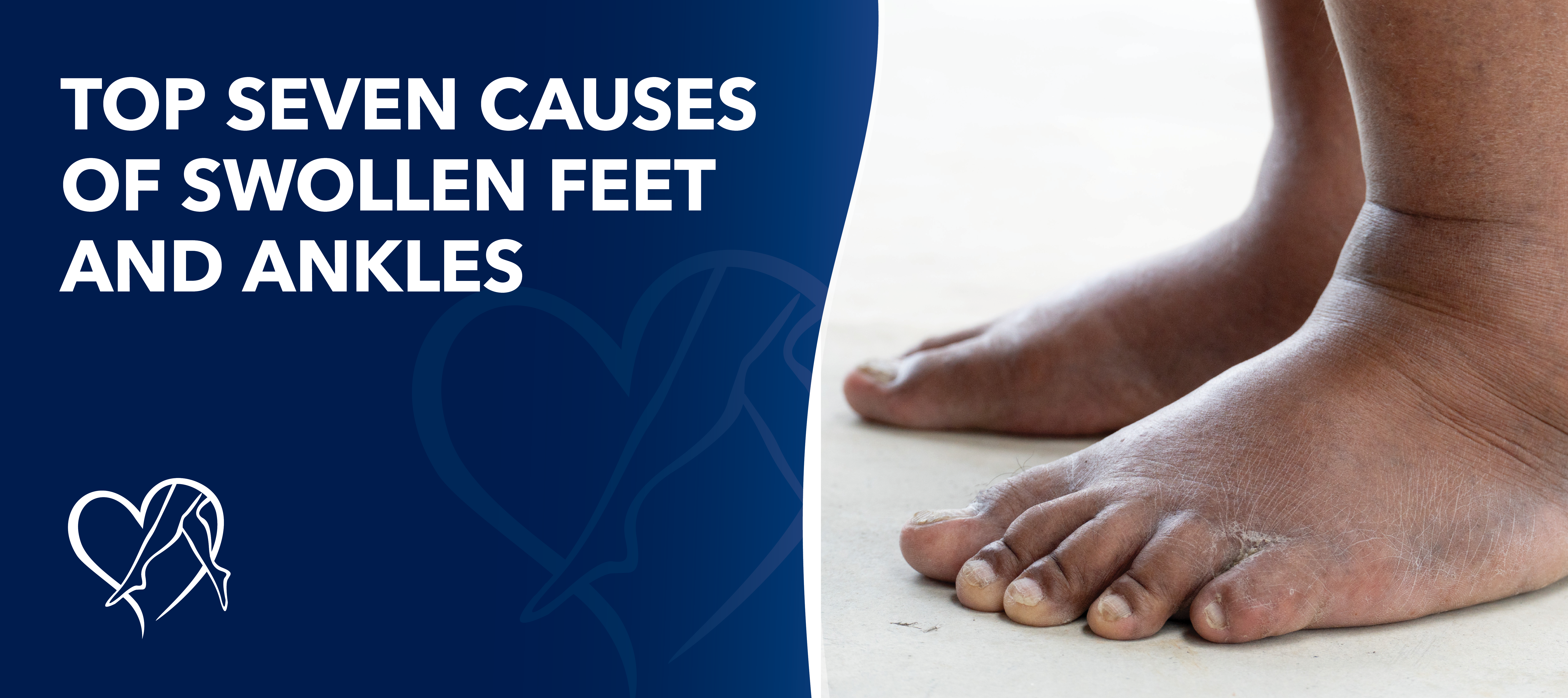 Top Seven Causes of Swollen Feet and Ankles