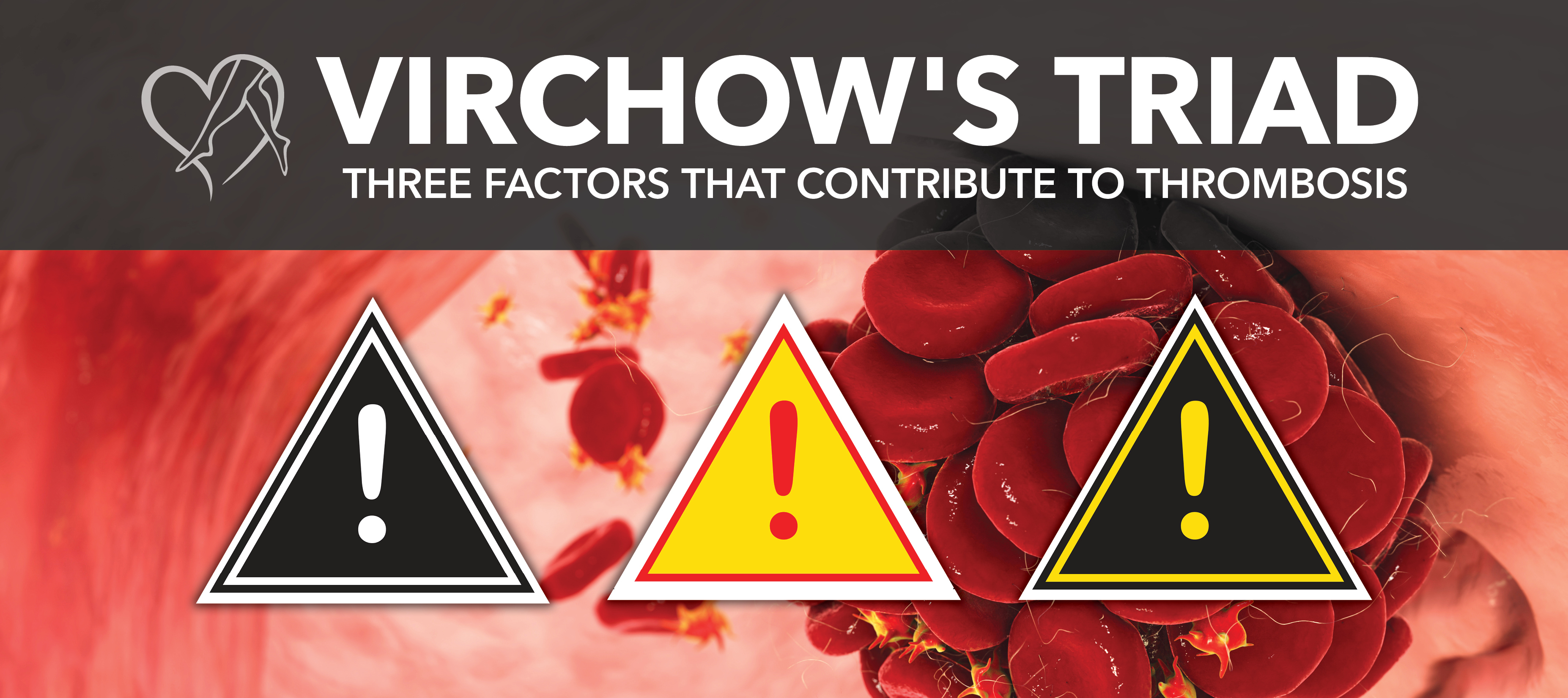 Center for Vein Restoration | La Tríada de Virchow: Tres Factores que ...