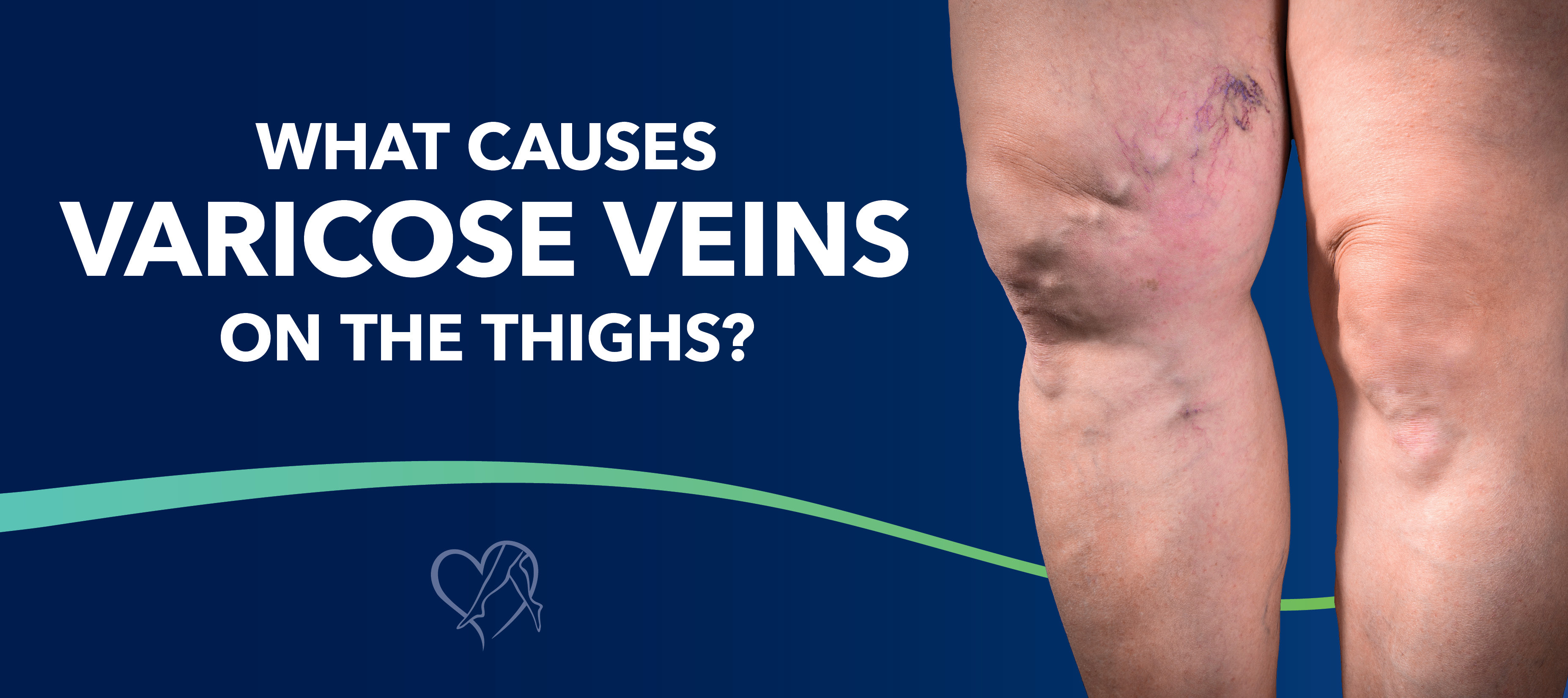 Center for Vein Restoration | ¿Qué Causa las Várices en los Muslos?
