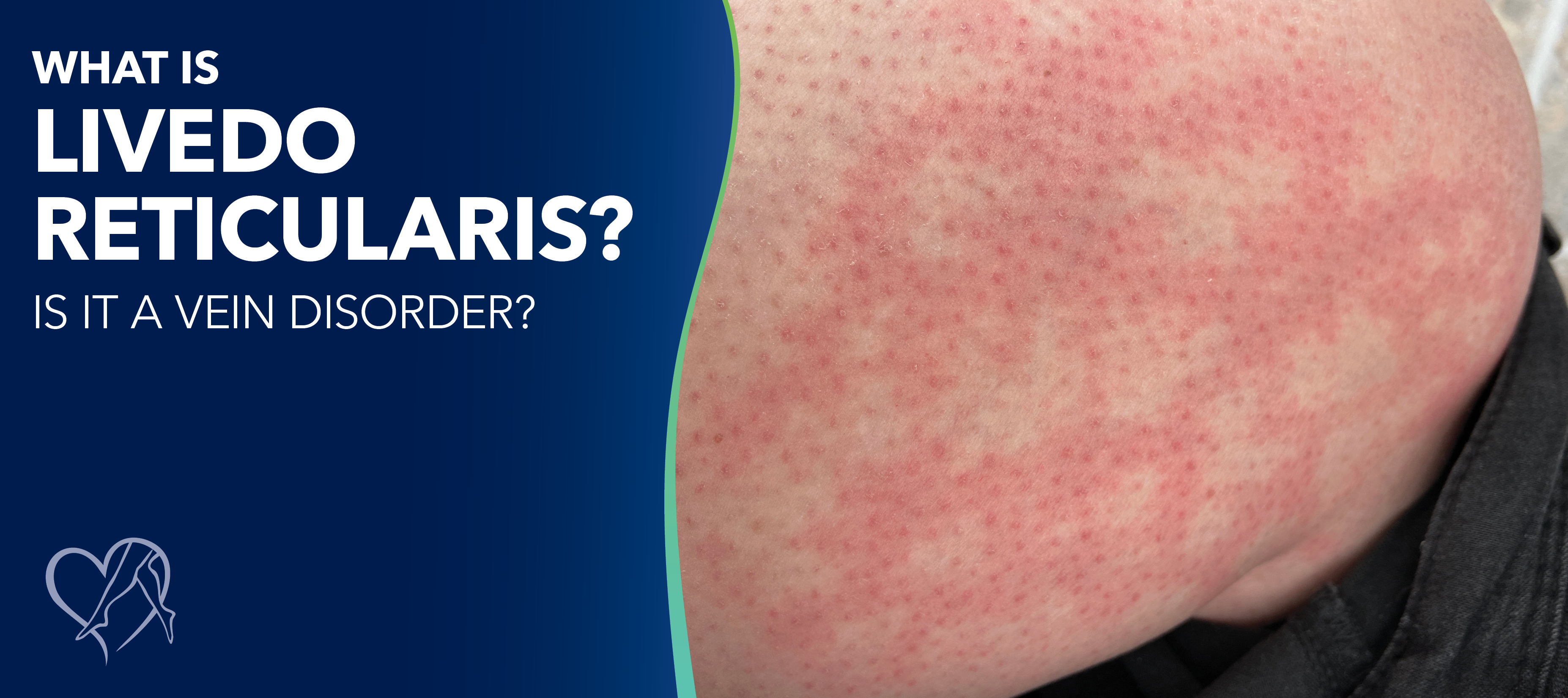 What Is Livedo Reticularis? Is It a Vein Disorder?