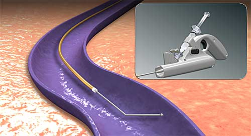 Clarivein Treatment Options & Plan Information | CVR
