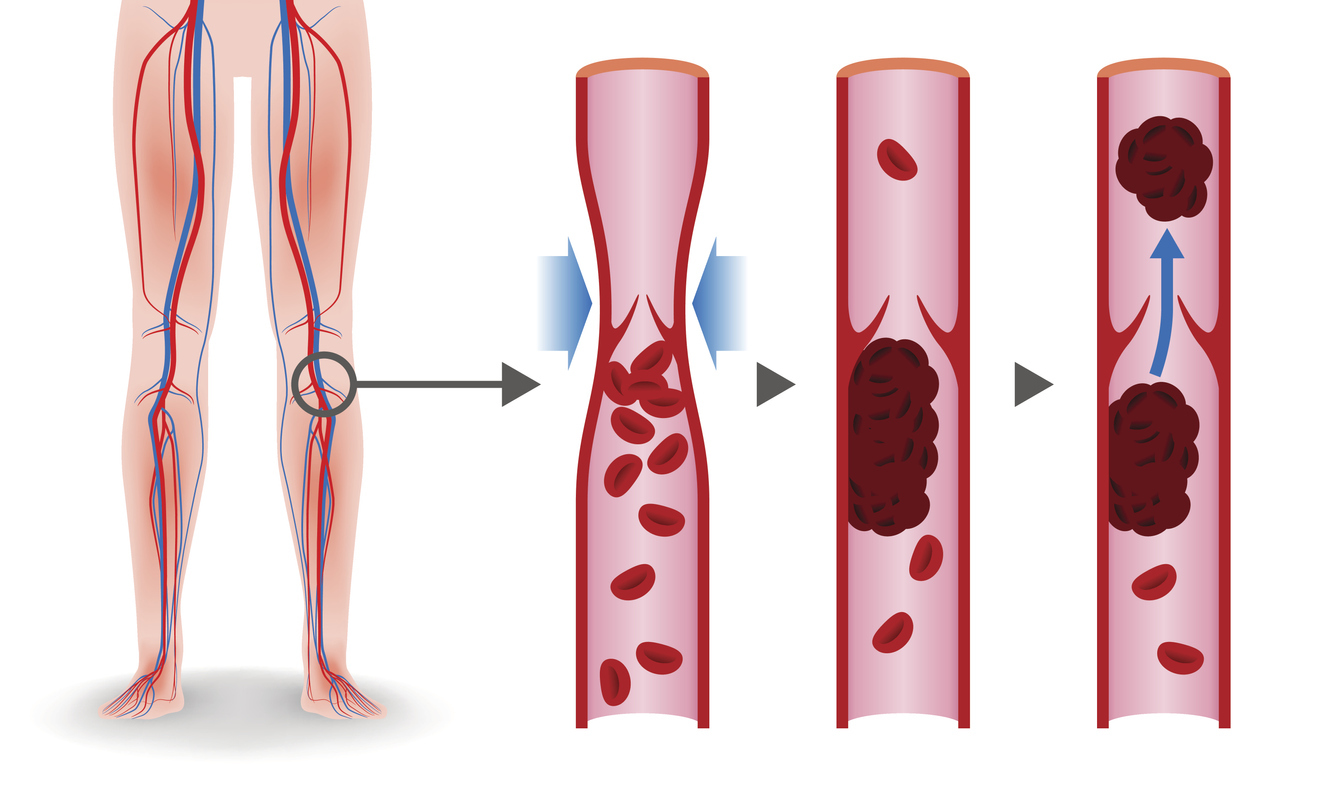 How to Check for Poor Blood Circulation at Home (and What to Do About It!)