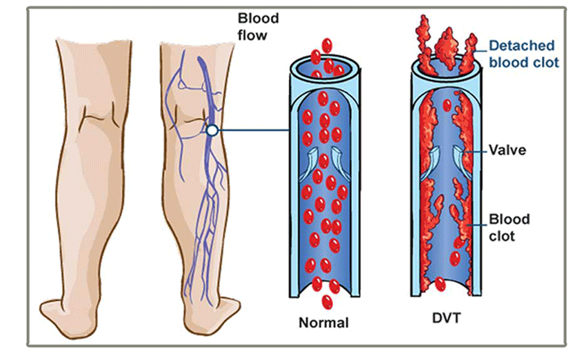The Difference between DVT and EHIT | Deep Vein Thrombosis