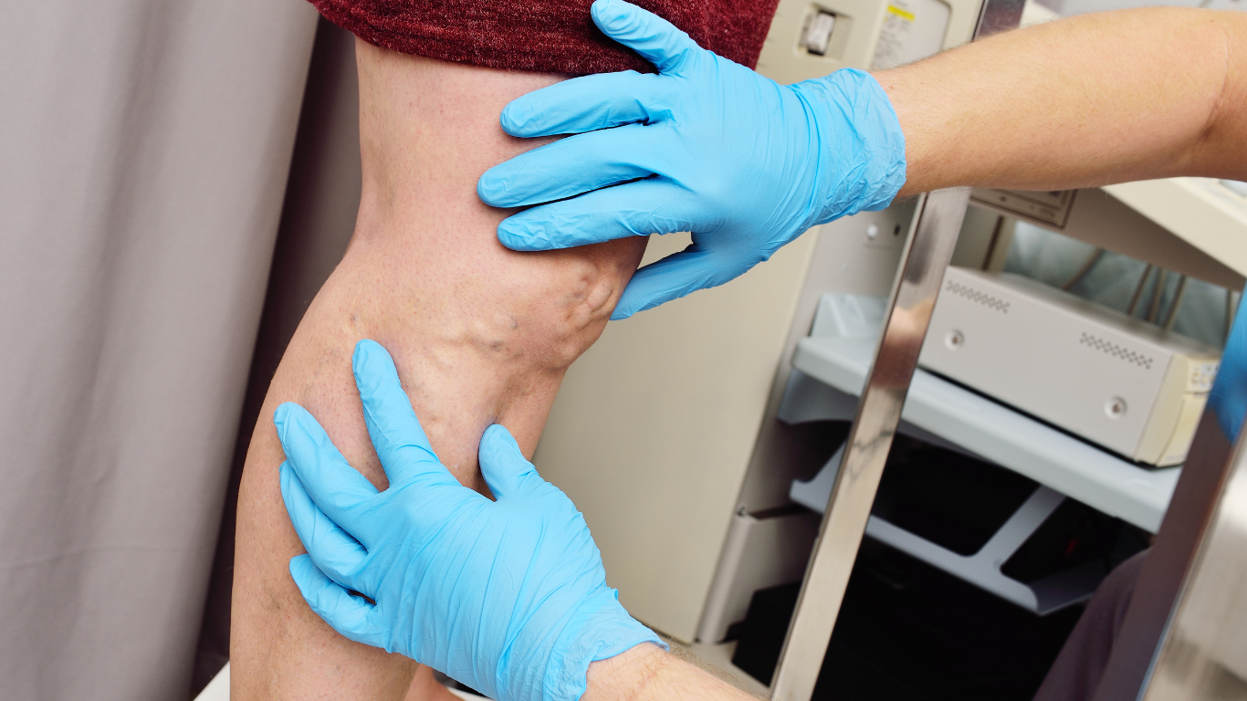 What Are the 4 Signs of Phlebitis? | Expert Vein Specialists